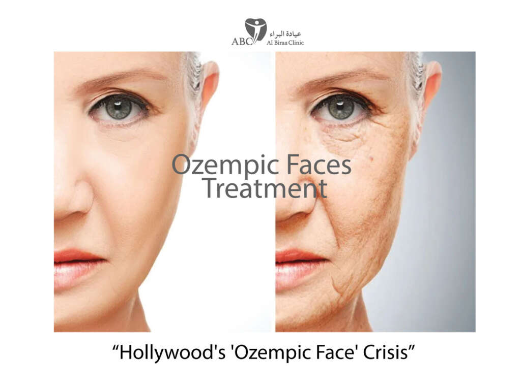 Unlocking the Beauty of Ozempic Faces by Al Biraa Clinic Dubai