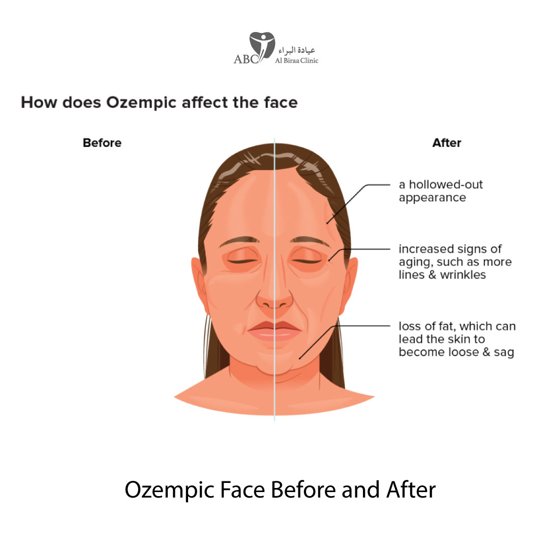 Unlocking the Beauty of Ozempic Faces by Al Biraa Clinic Dubai