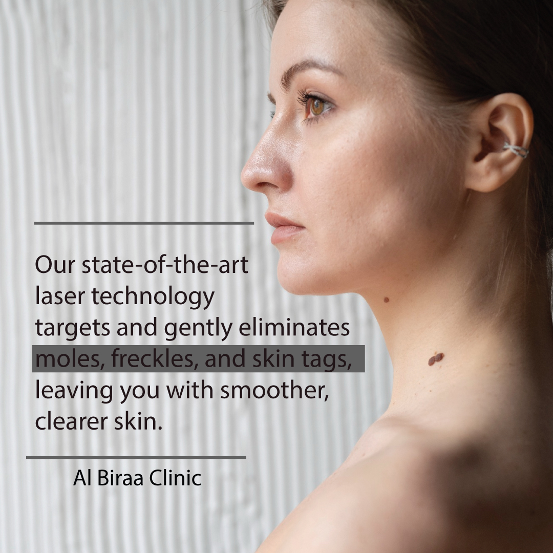 Laser Skin Tag Removal Treatment in Dubai| Best Skin Tag Removal Clinic